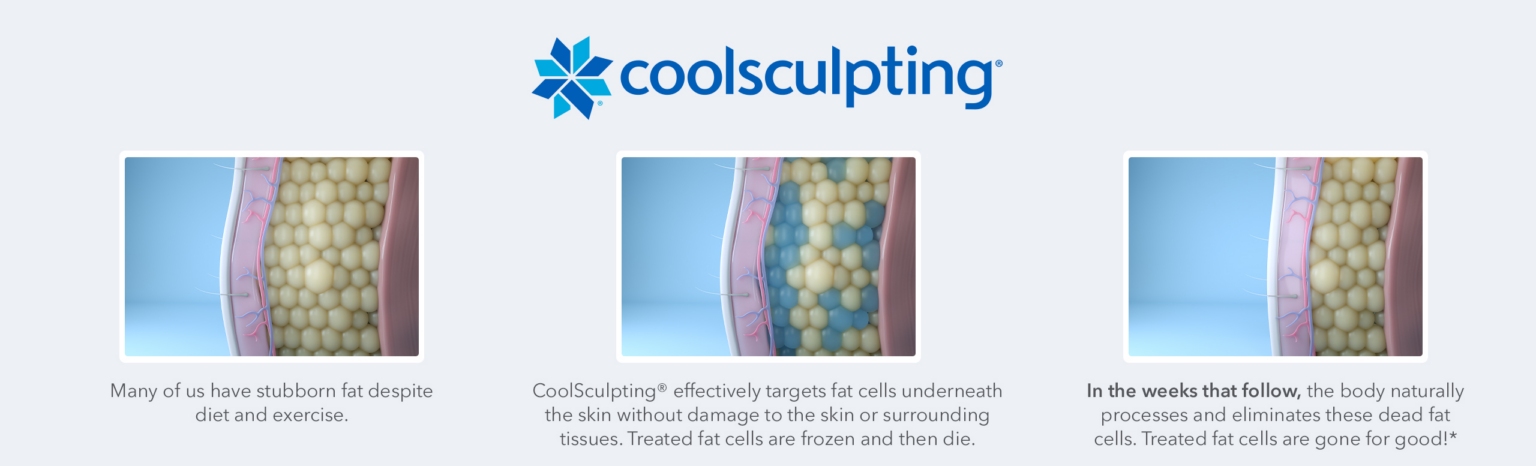 CoolSculpting® - MetroDerm & Center For Plastic Surgery